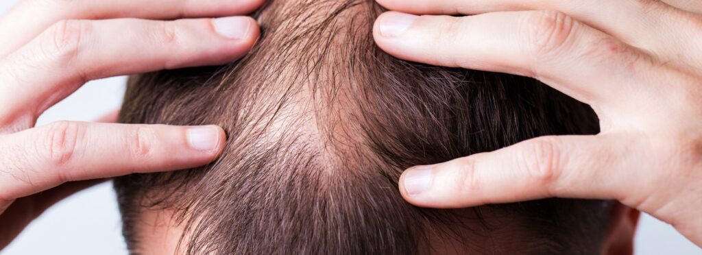 Calvitie : Comment la reconnaître et la traiter efficacement | Clinique ...